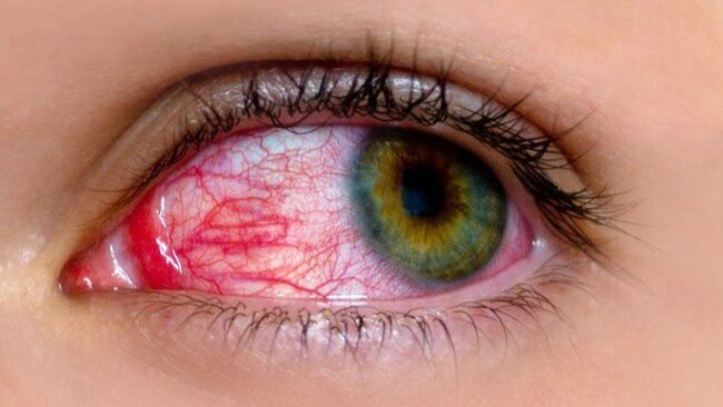 Apollo Eye in Children: knowing the Spread and Prevention